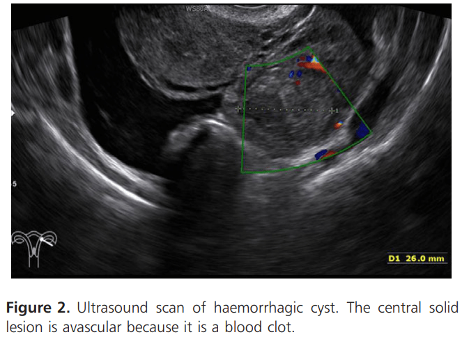 Management of adnexal masses in pregnancy – journey to be a specialist