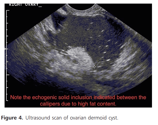 Management of adnexal masses in pregnancy – journey to be a specialist
