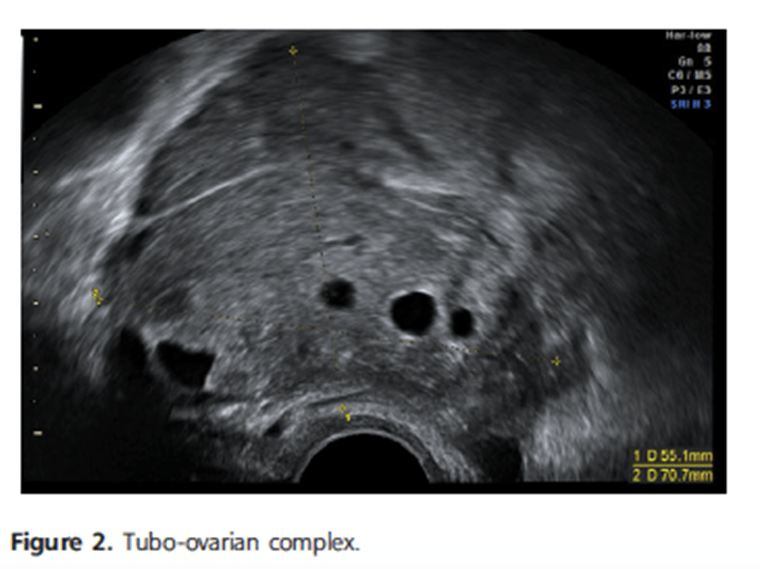 Tubo Ovarian Abscess Journey To Be A Specialist